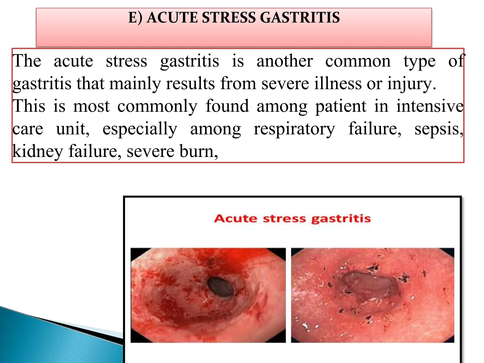 Gastritis.pptx Gastro Intestinal Disorder | PPTX | Digestive Disorders ...