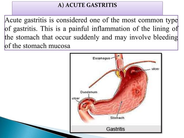 Gastritis.pptx Gastro Intestinal Disorder | PPTX | Digestive Disorders ...