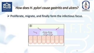 Gastritis including H. pylori for undergraduate | PPTX