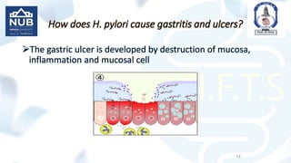 Gastritis including H. pylori for undergraduate | PPTX