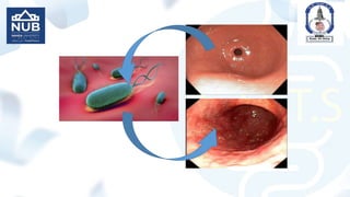 Gastritis including H. pylori for undergraduate | PPTX