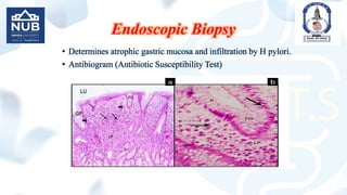 Gastritis including H. pylori for undergraduate | PPTX