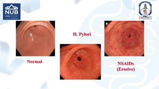 Gastritis including H. pylori for undergraduate | PPTX