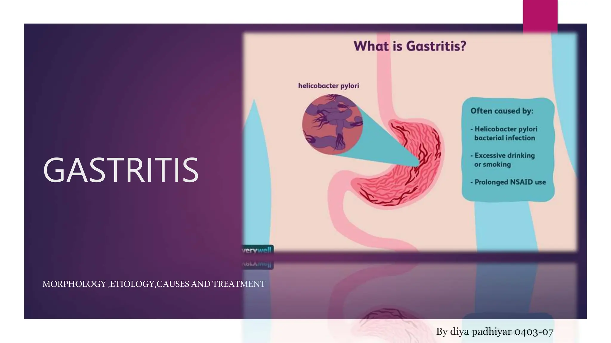MORPHOLOHY,ETIOLOGY AND TREATMENT OF GASTRITIS .pptx
