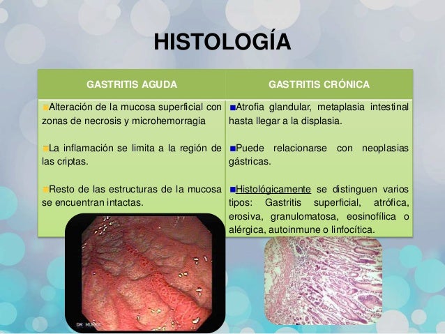 Gastritis aguda-y-crónica