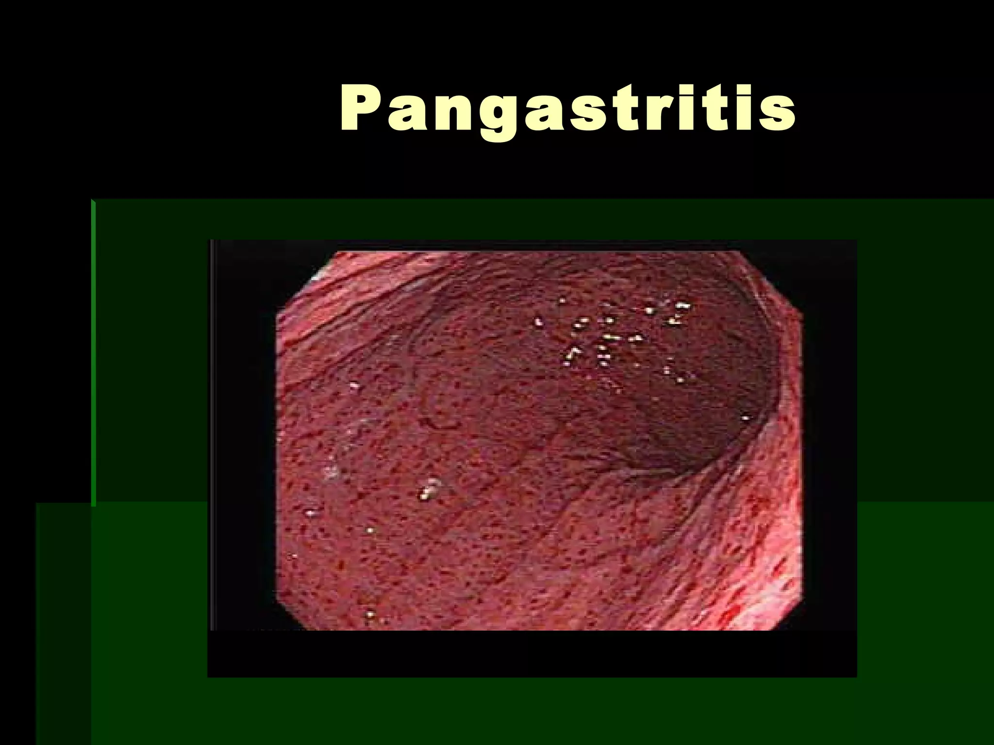 Gastritis aguda y cronica 1 | PPT
