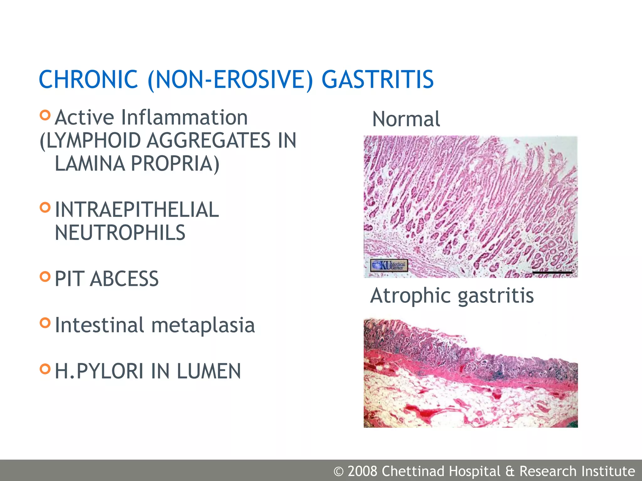 Gastritis and peptic ulcer 30 5-2016 | PPS