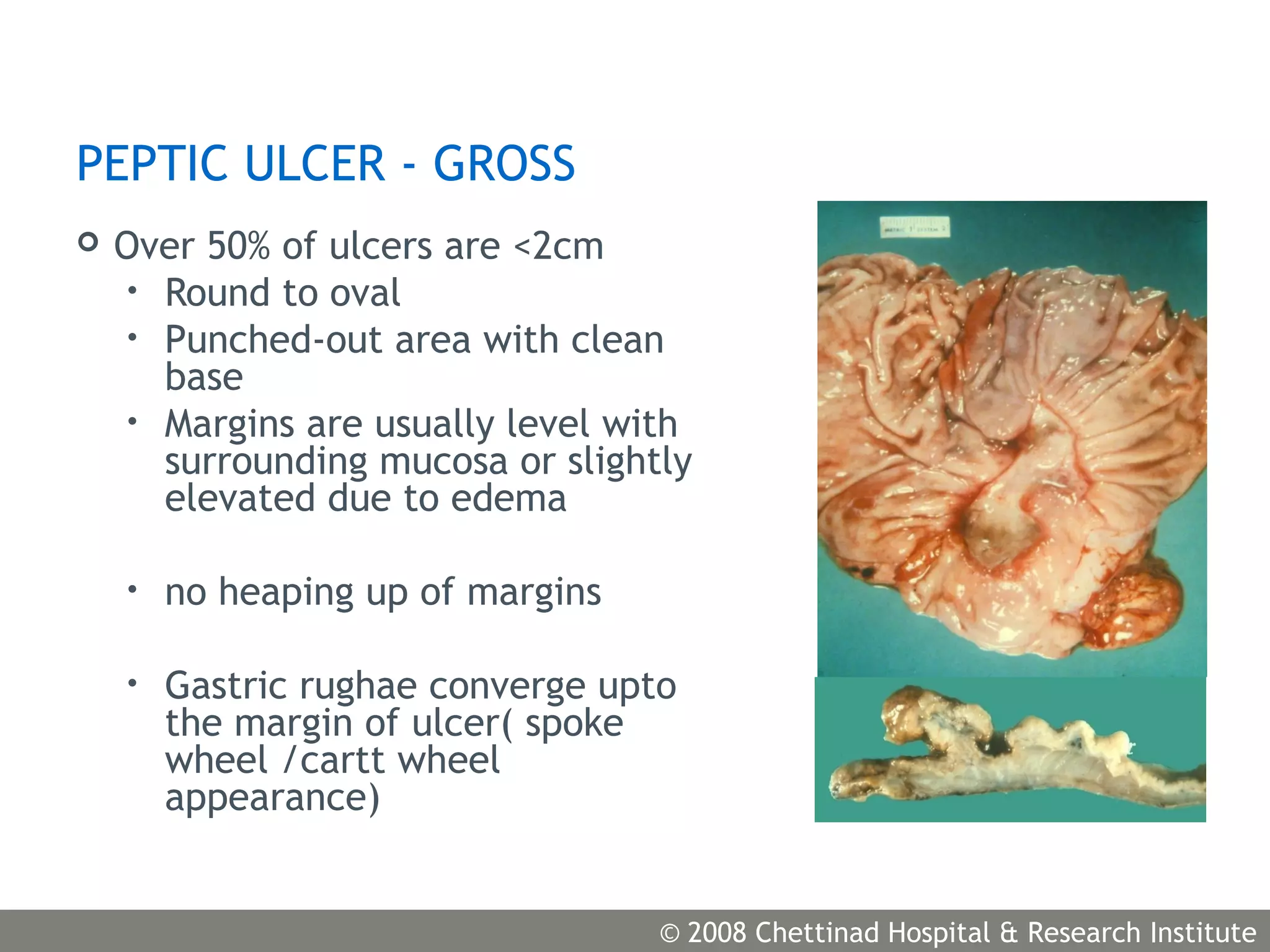Gastritis and peptic ulcer 30 5-2016 | PPS
