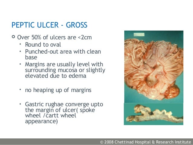 Gastritis and peptic ulcer 30 5-2016