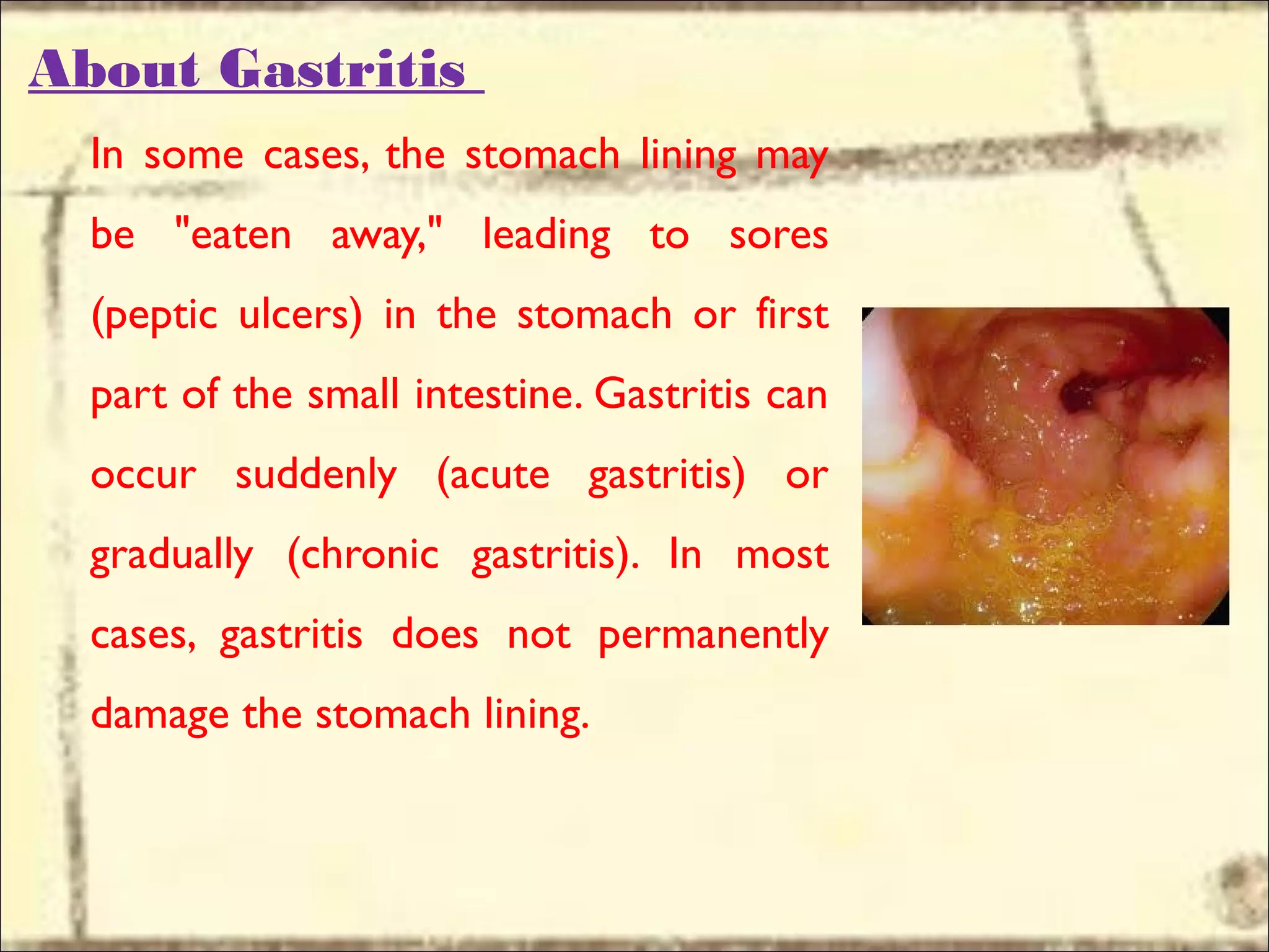 Gastritis (original) | PPT