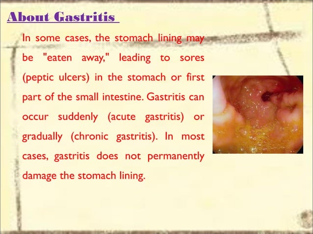 Gastritis (original) | PPT