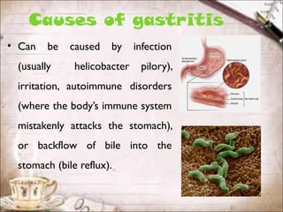 Gastritis (original) | PPT