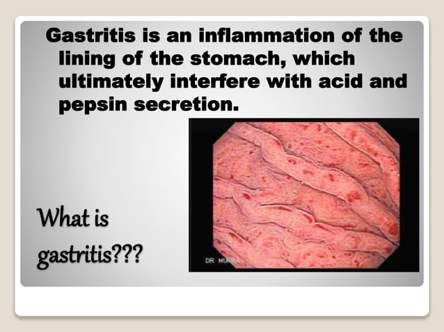 Topic: Gastritis Nursing Lecture ppt.ppt | Digestive Disorders ...