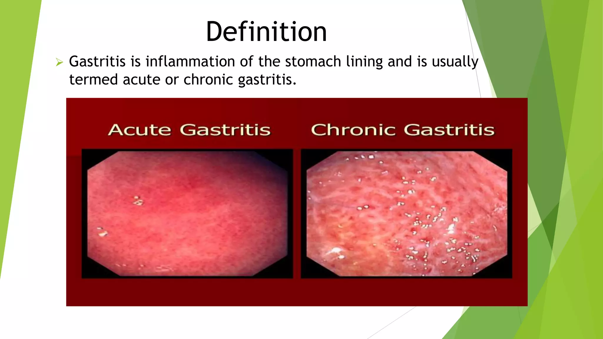Gastritis | PPTX