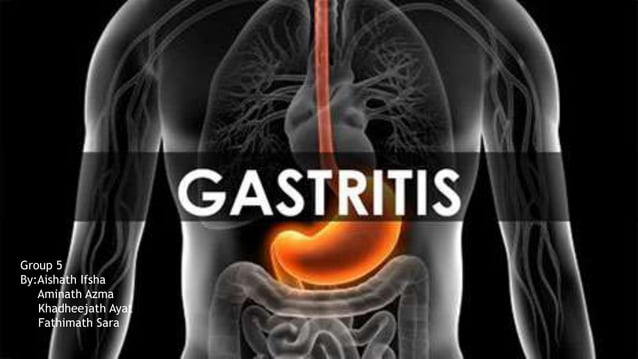 Gastritis | PPTX