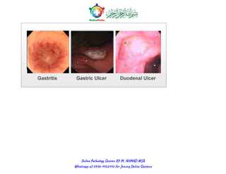 Gastritis & Ulcers marked.pdf MBBS 4th year | PDF