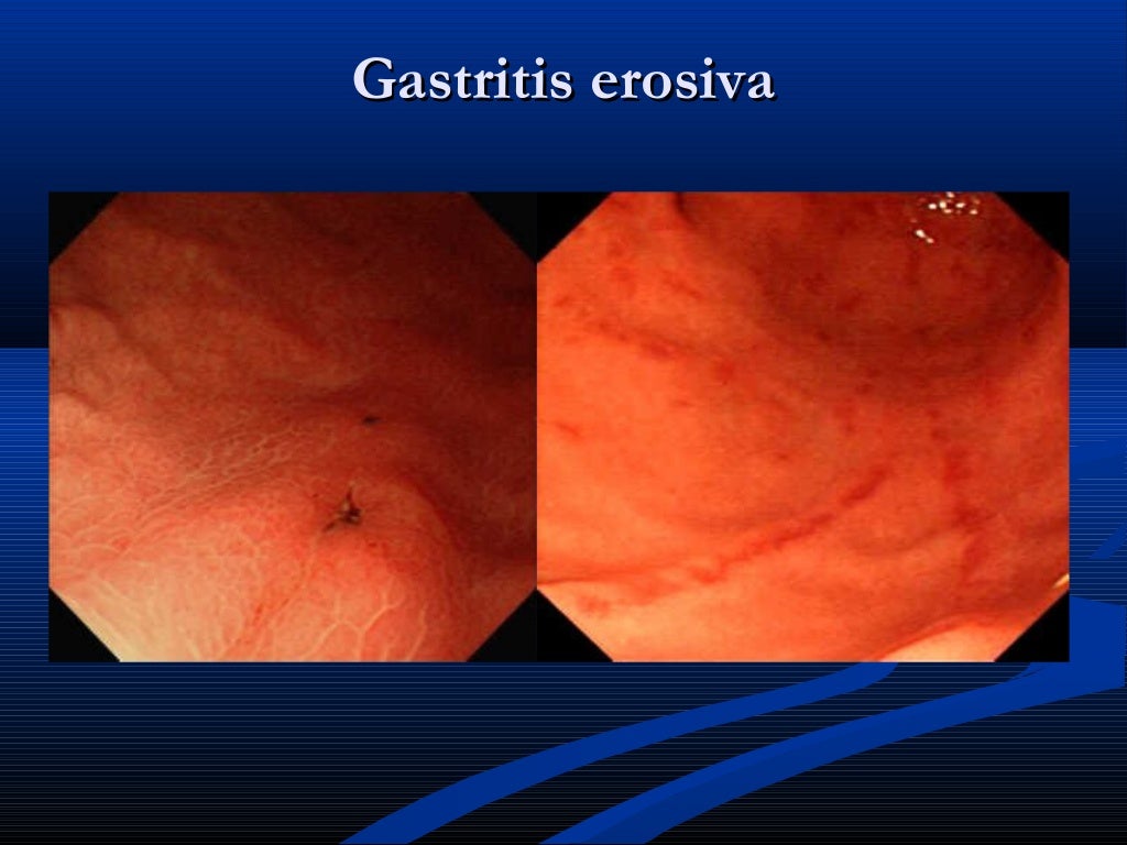 Gastritis y gastropatias