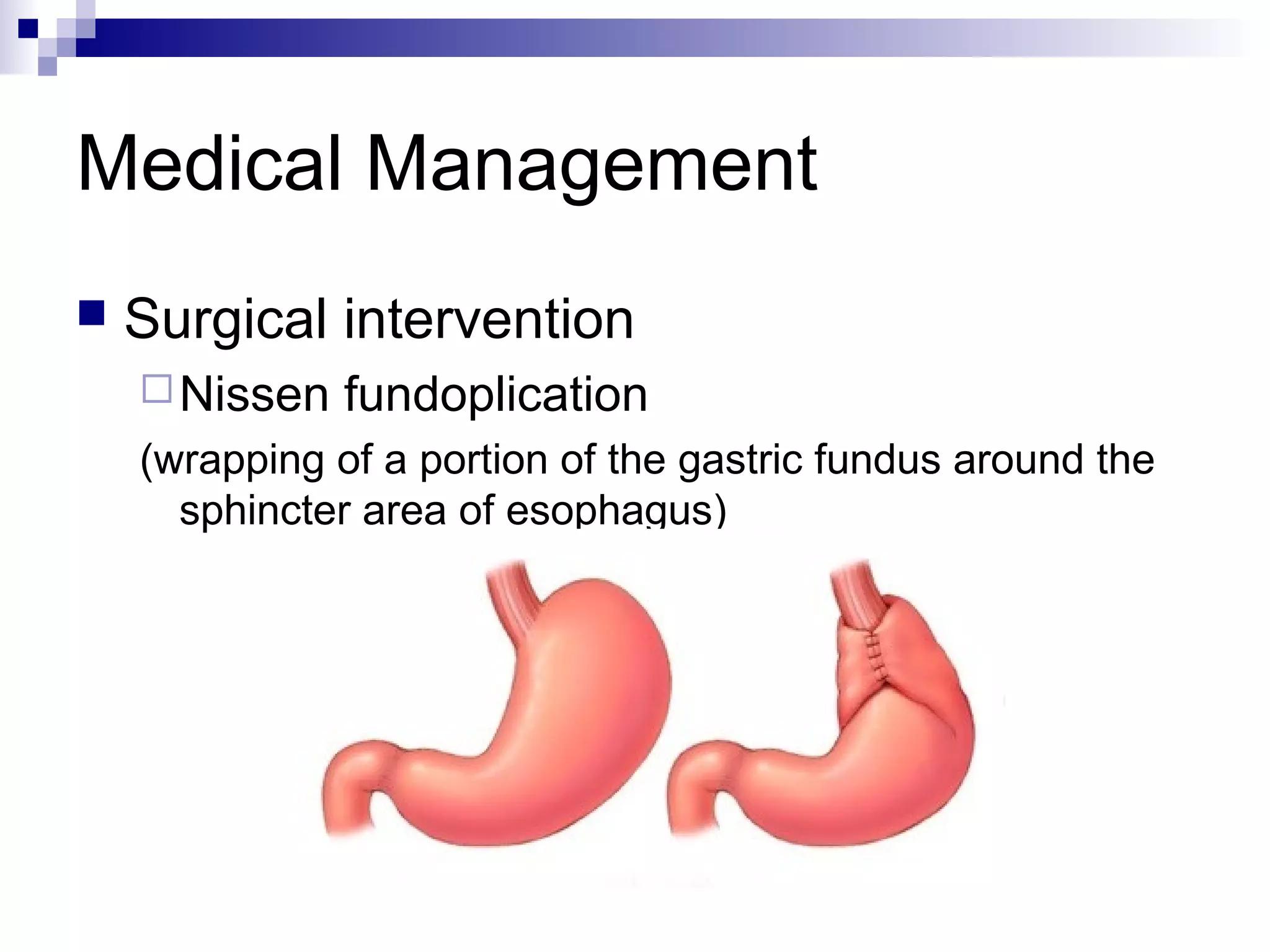 Gastro esophageal reflux disease (GERD) | PPT