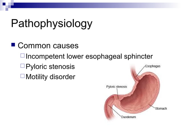 Gastro esophageal reflux disease (GERD) | PPT | Digestive Disorders ...