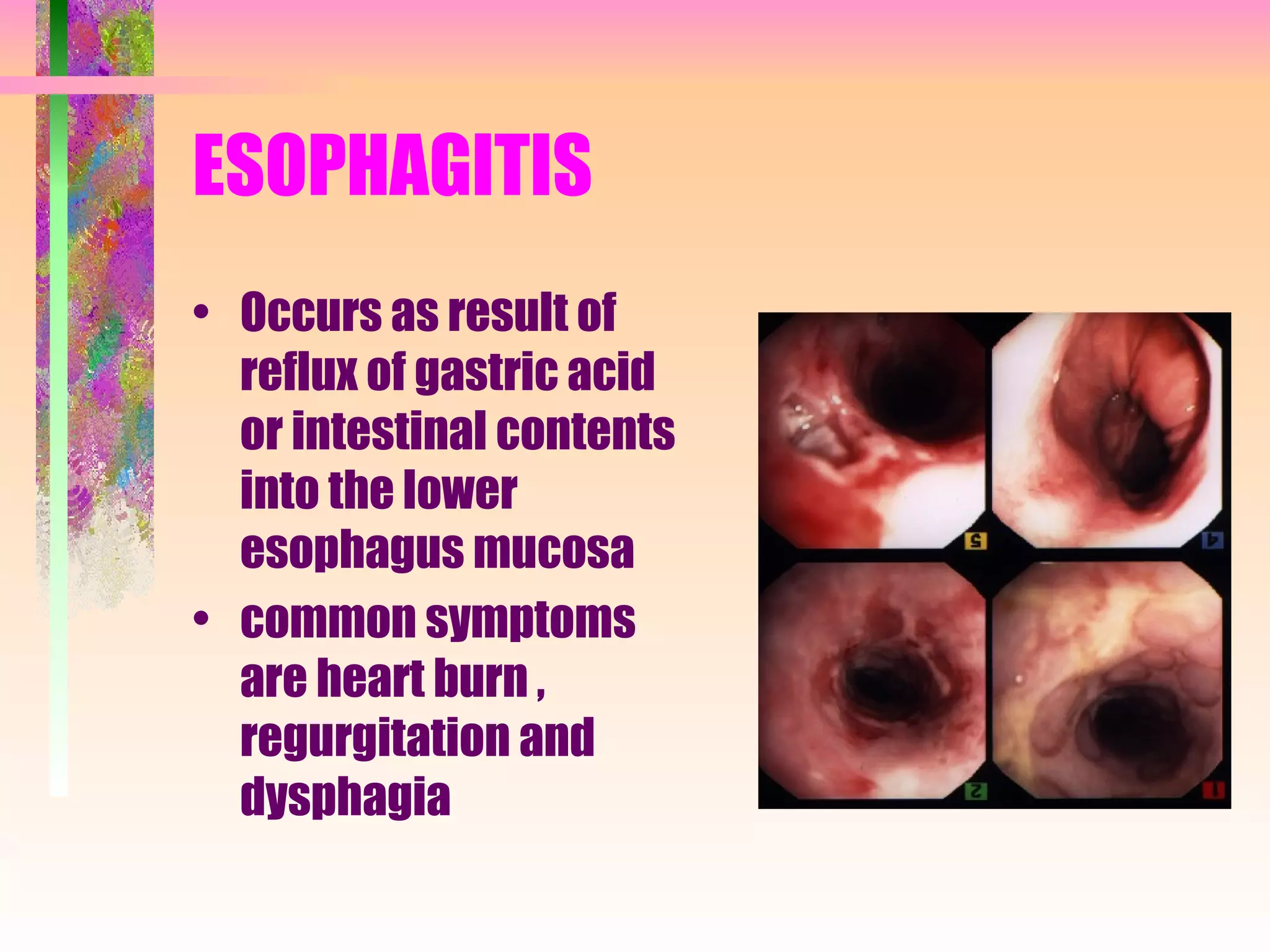 Gastro Intestinal Diseases | PPT