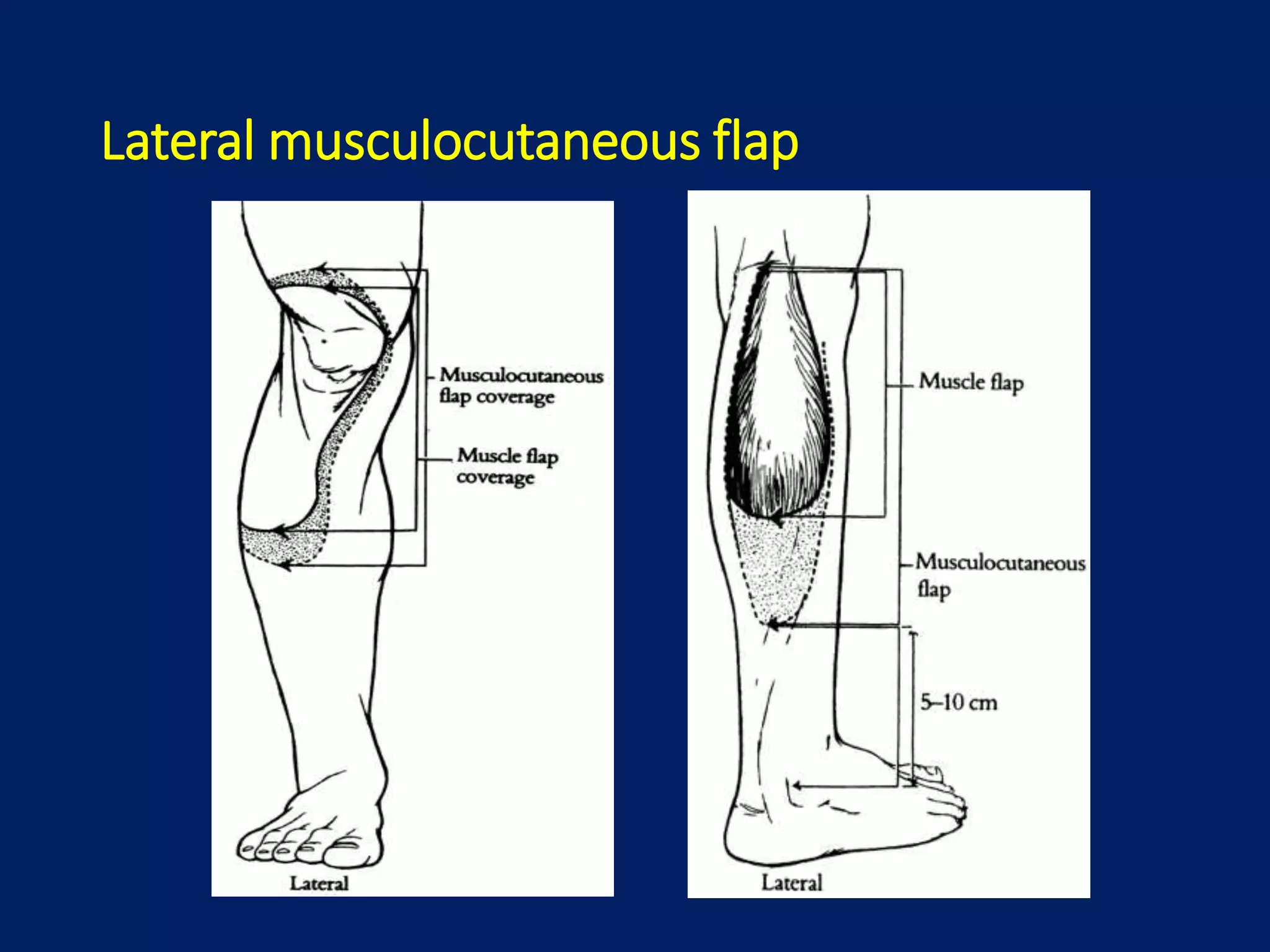 Gastrocnemius flap | PPTX