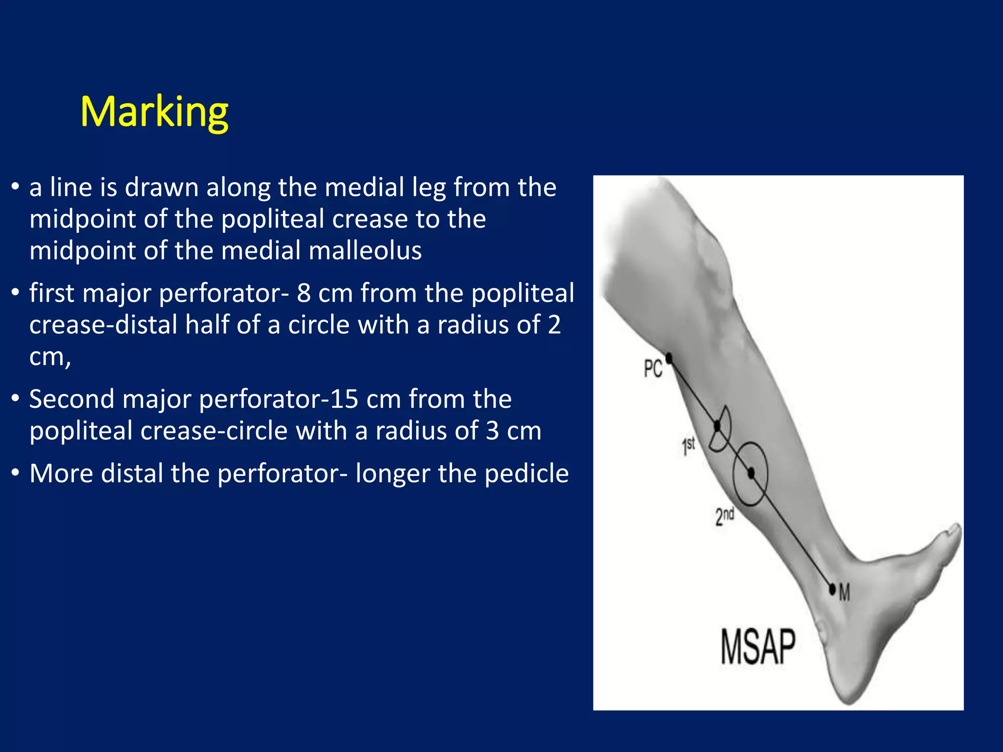Gastrocnemius flap | PPTX