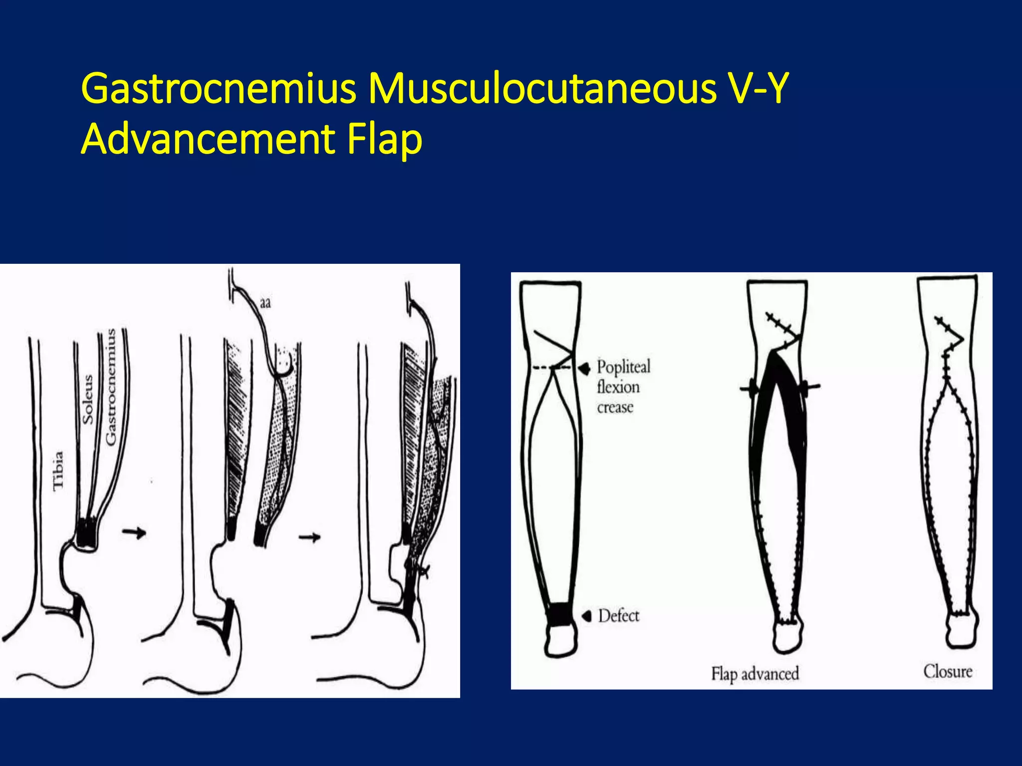 Gastrocnemius flap | PPTX