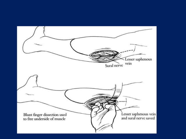 Gastrocnemius flap | PPTX | Death, Injury, or Military Conflict ...