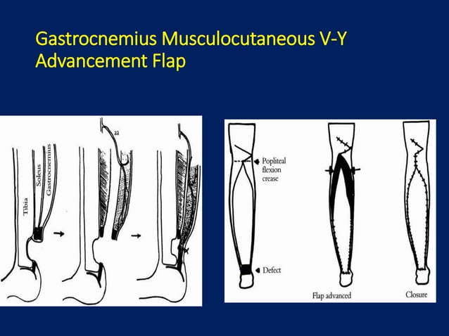 Gastrocnemius flap | PPTX | Death, Injury, or Military Conflict ...