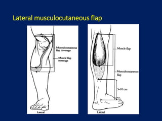 Gastrocnemius flap | PPT