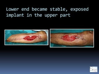 Gastrocnemius Muscle Flap | PPTX