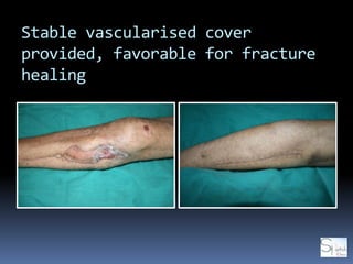 Gastrocnemius Muscle Flap | PPTX