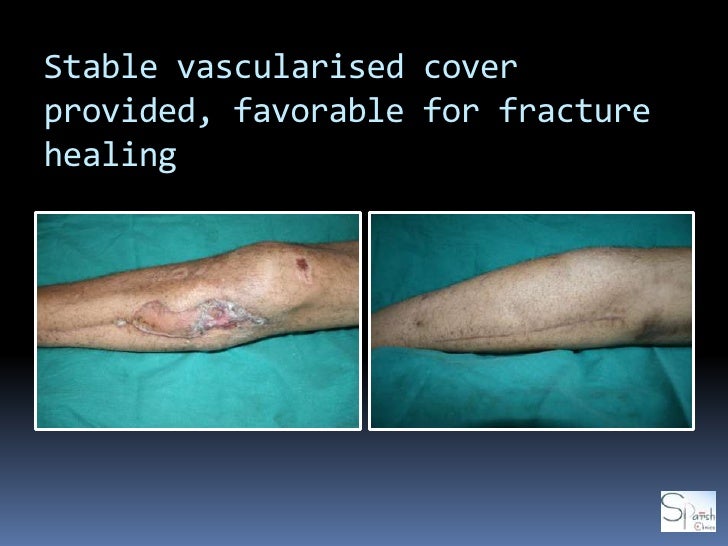 Gastrocnemius Muscle Flap