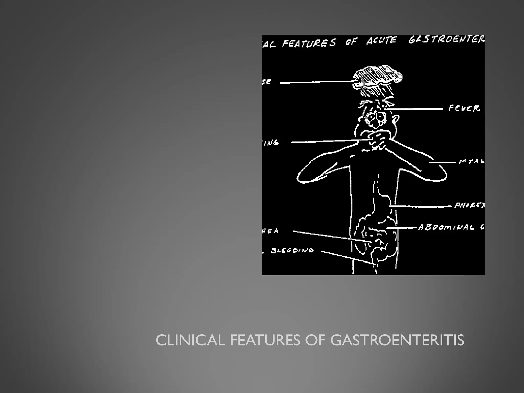 Gastroenteritis | PPT