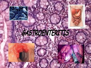 Gastroenteritis | PPT