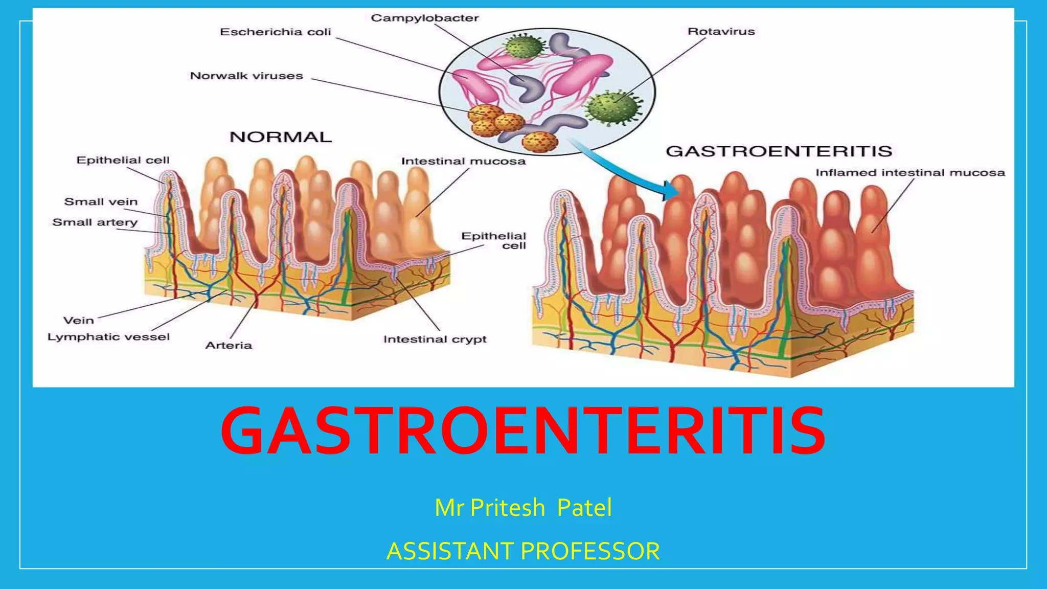 Gastroenteritis.pptx