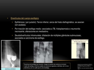 defectos anatómicos del esófago | PPT