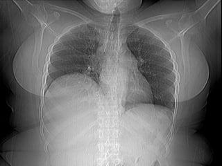 Gastroenteropancreatic neuroendocrine tumors h | PPT