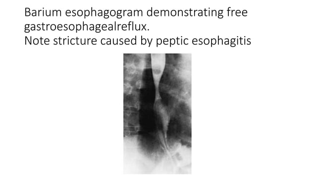 Gastroesophageal reflux disease pediatrics | PPTX | Parenting Babies ...