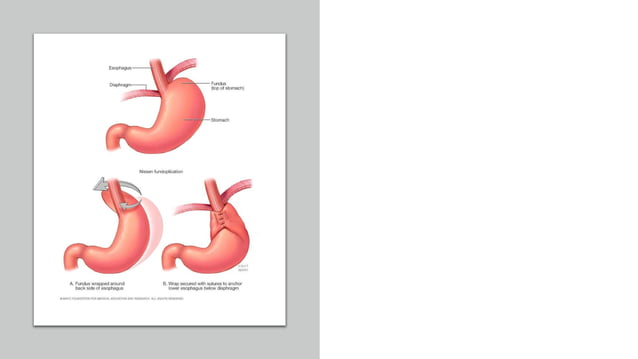 Gastroesophageal reflux disease pediatrics | PPTX | Parenting Babies ...
