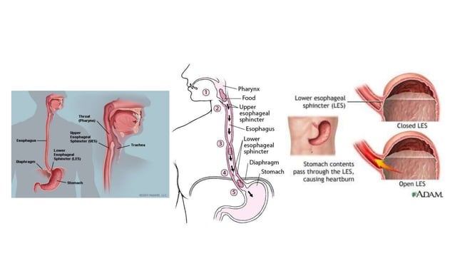 Gastroesophageal reflux disease pediatrics | PPTX | Parenting Babies ...