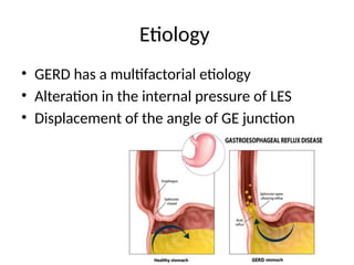 Gastroesophageal reflux disease and itsnursingmanagement .pptx