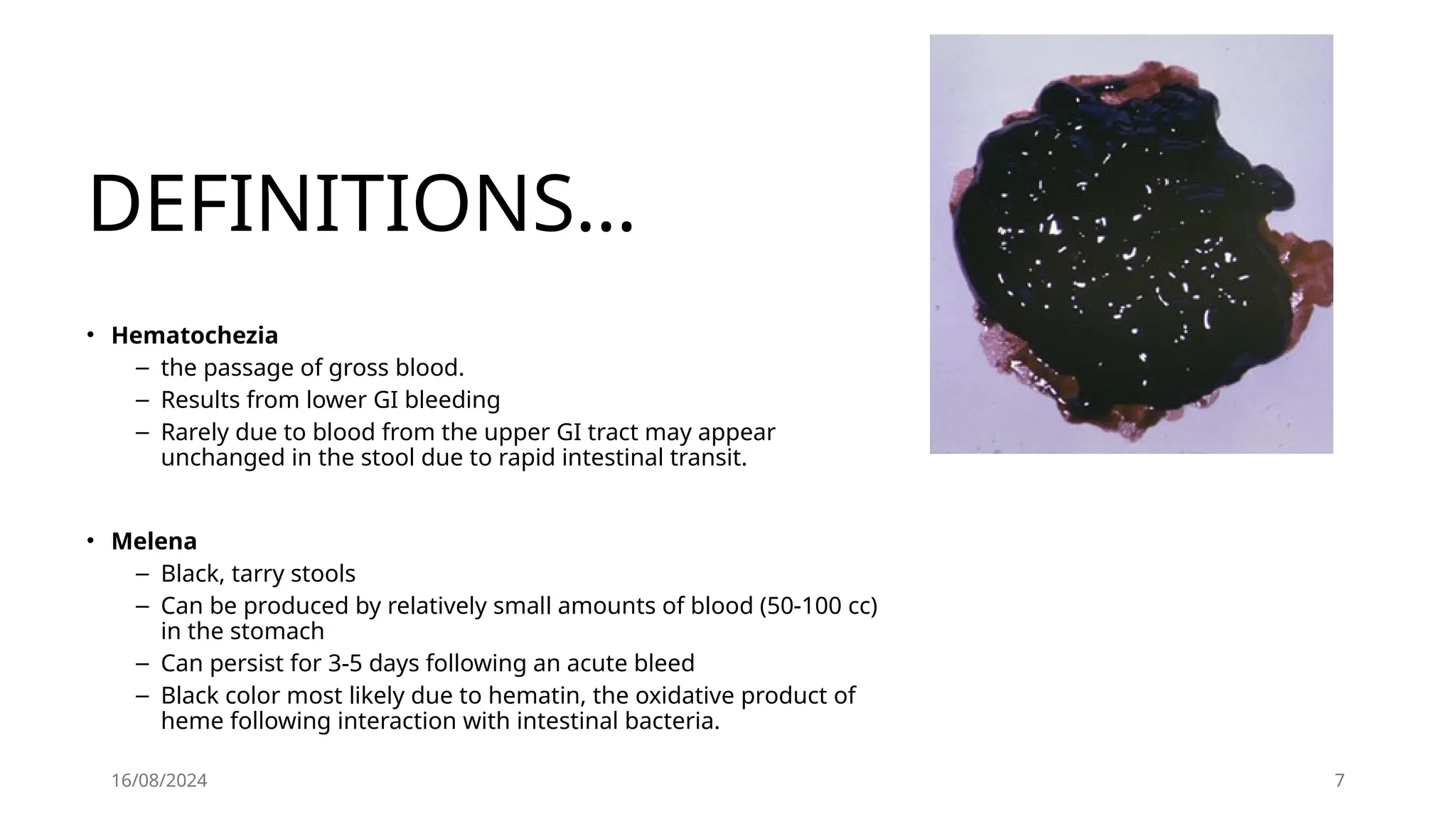 GASTROINTESTINA BLEEDING in paediatrics. | PPTX