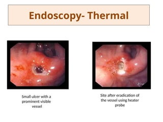 Fundamentals of GASTROINTESTINAL-BLEEDING.ppt
