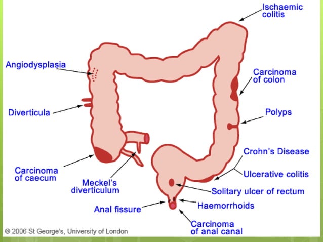 Gastro Intestinal bleeding.pptx