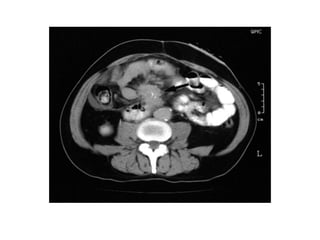 Gastrointestinal carcinoids | PPTX
