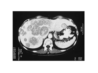 Gastrointestinal carcinoids | PPTX