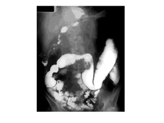 Gastrointestinal carcinoids | PPT