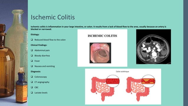 Gastrointestinal Disorders. Ischemic colitis, colon polyps, colorectal ...