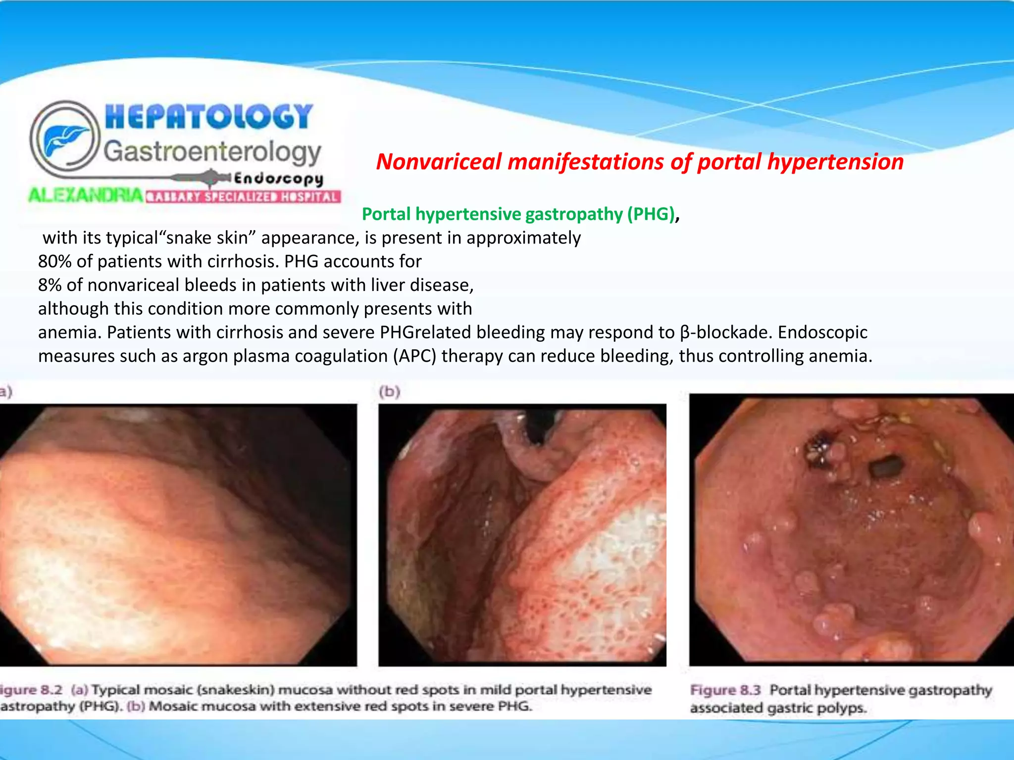 Gastrointestinal dysfunction in liver cirrhosis | PPTX